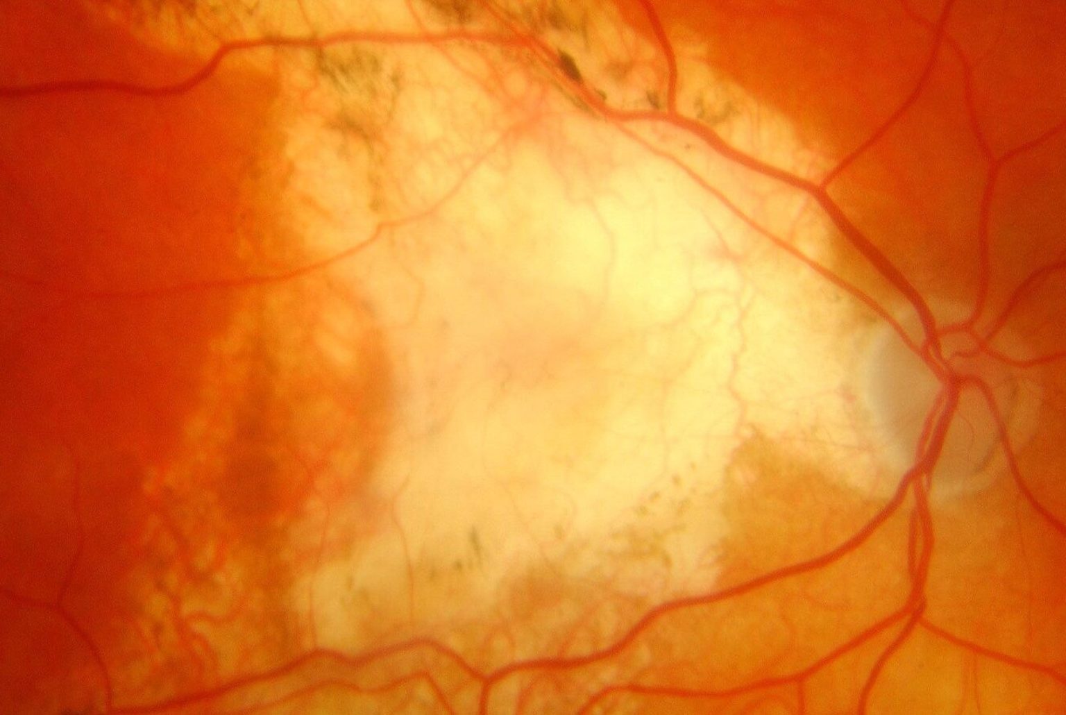 Understanding Uveitis – A Guide for Patients – IUSG